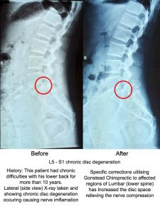 Chronic Lower Back Discomfort caused by Disc Degeneration - A ...