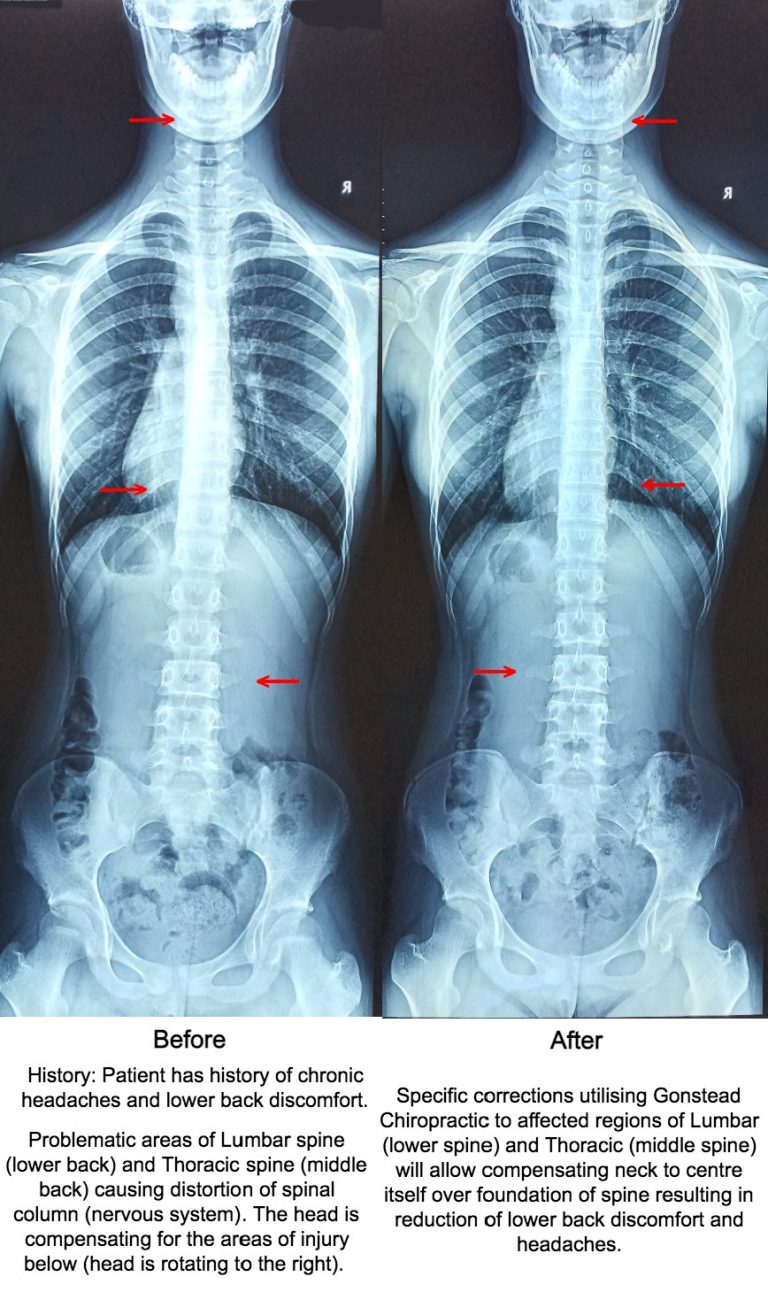 Spinal misalignments of Lumbar and Thoracic spine causing compensatory ...