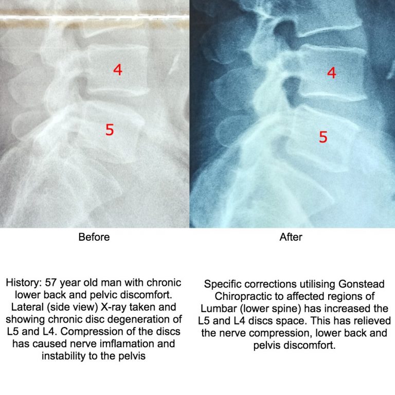 Reversal of L5 and L4 Disc Degeneration - A Chiropractic Clinic ...