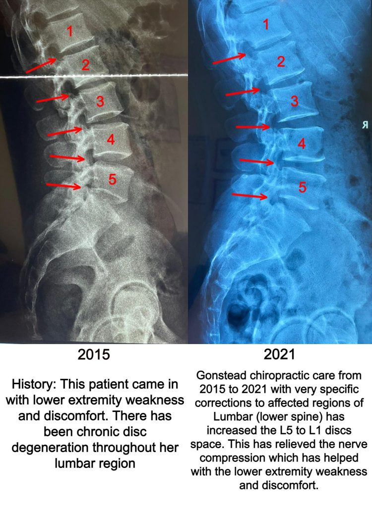 Disc Preservation Utilising Gonstead Methodology from 2015 to 2021 - A ...