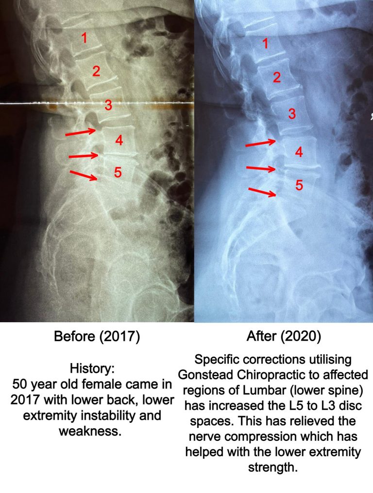 Weak Lower Extremities Due To Lumbar Disc Degeneration - A Chiropractic ...