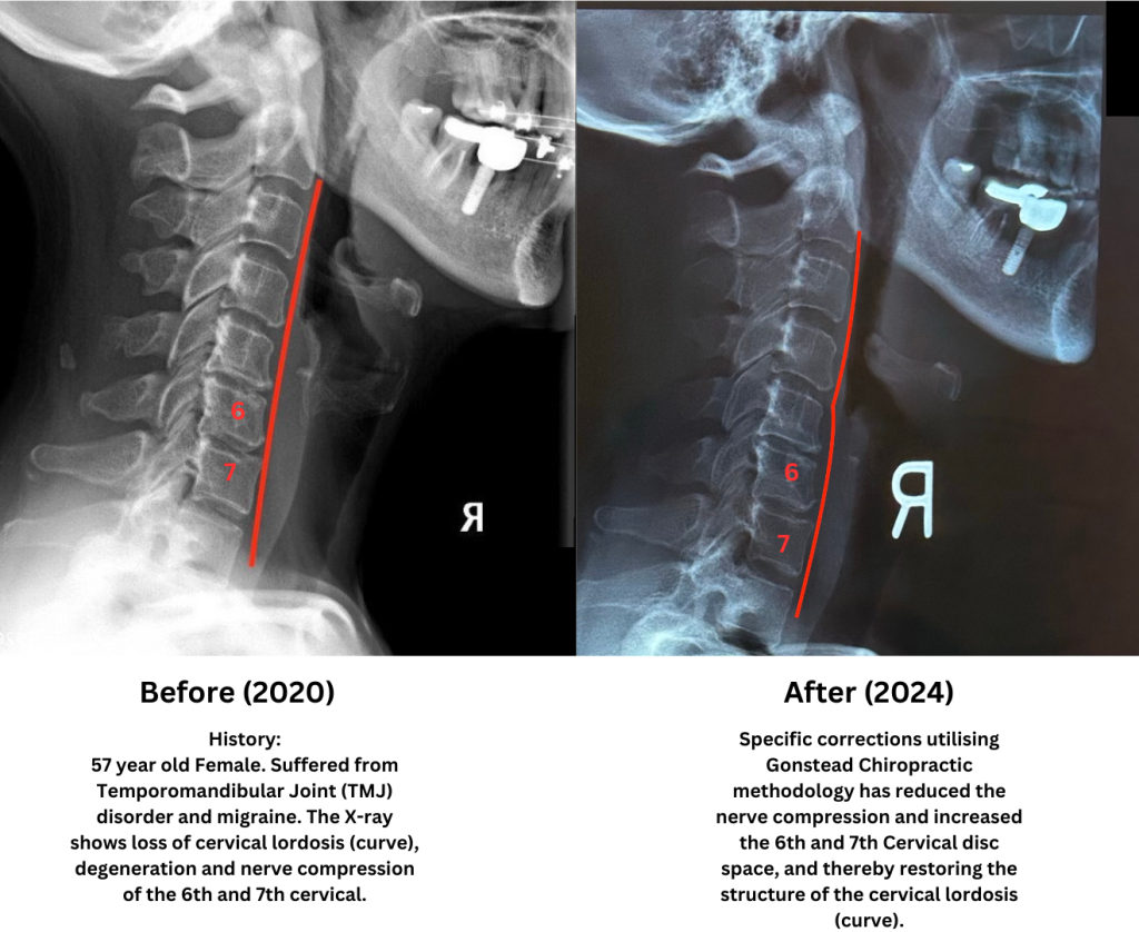 Degeneration of cervical spine - A Chiropractic Clinic utilizes ...